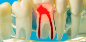 Reversible Pulpitis and Irreversible Pulpitis: Causes, Symptoms, and ...